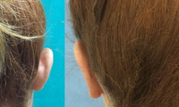 Oreja supernumeraria. Síntomas, causas y tratamientos de Oreja ...