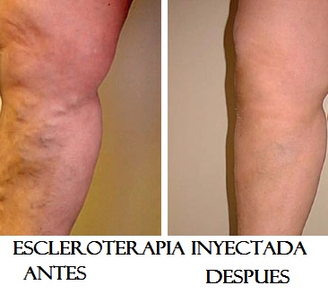 En qué consiste la operación de varices